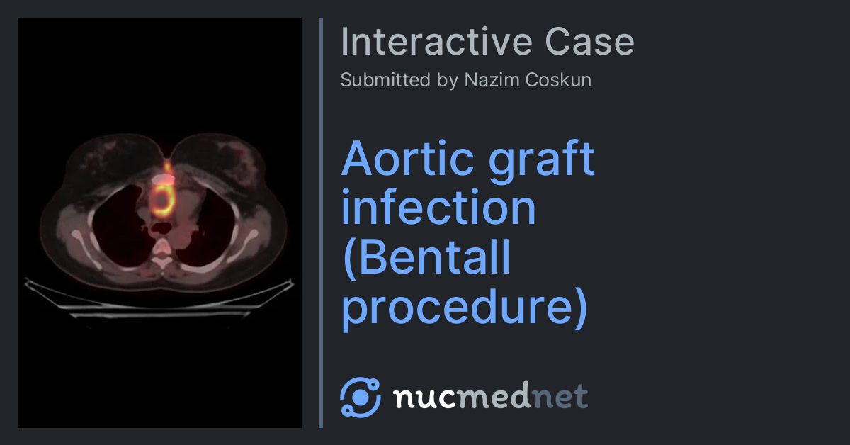 Aortic graft infection (Bentall procedure) · nucmed.net