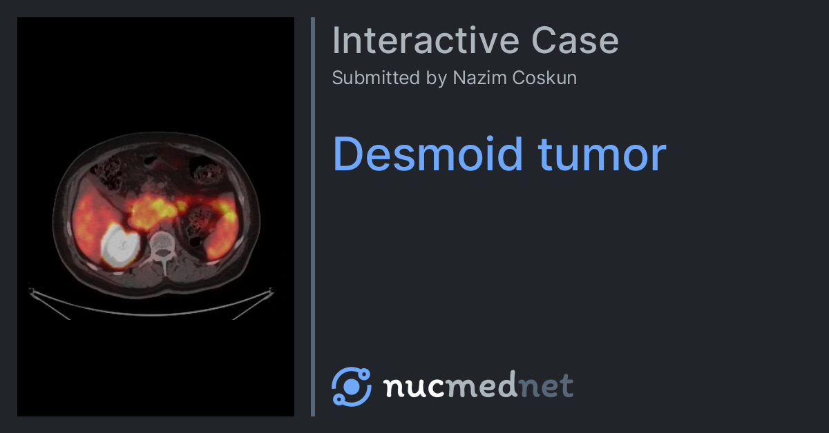 Desmoid tumor · nucmed.net