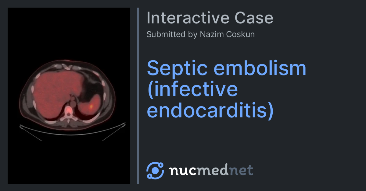 Septic embolism (infective endocarditis) · nucmed.net
