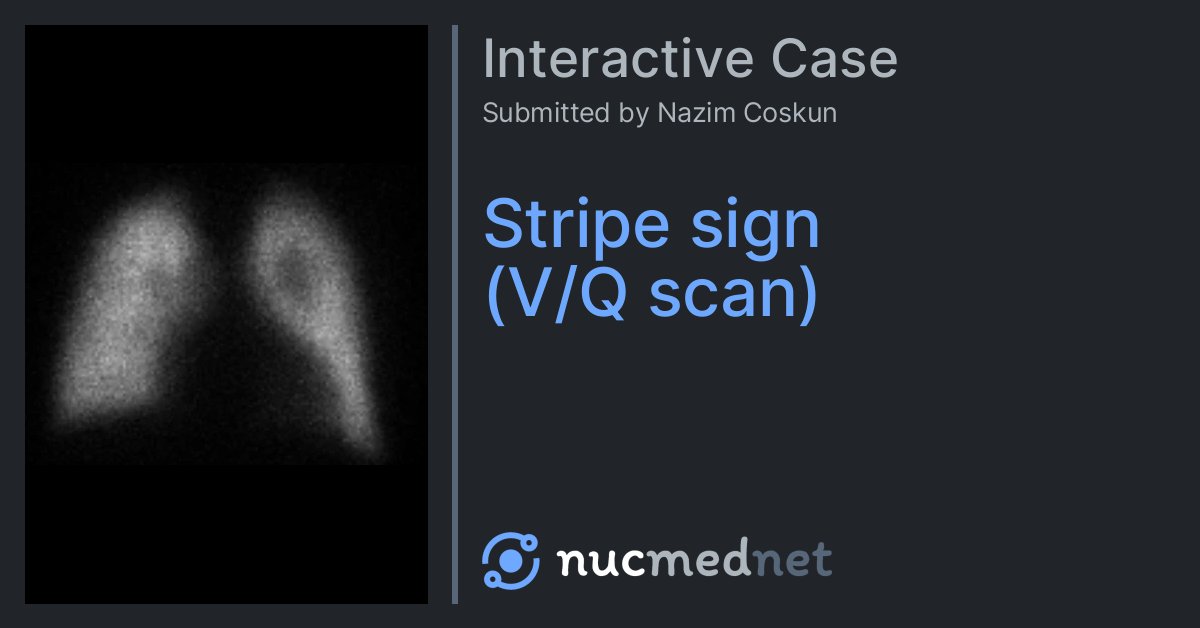 Stripe sign (V/Q scan) · nucmed.net